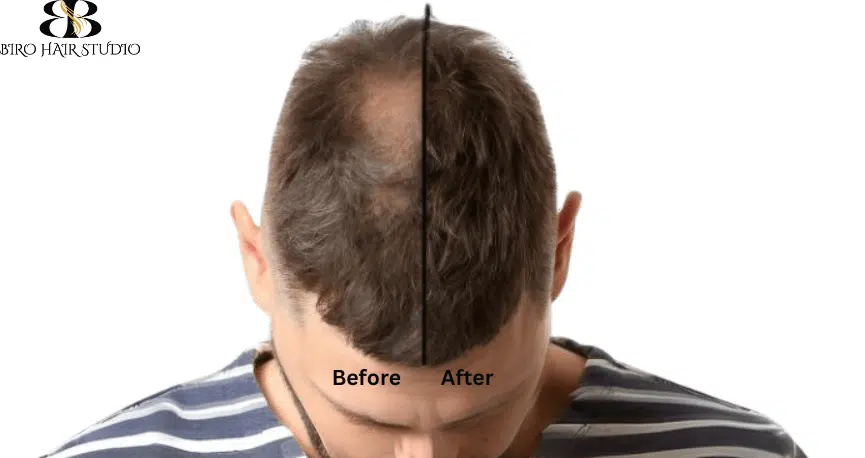 Non Surgical Hair Replacement System Service in Toronto